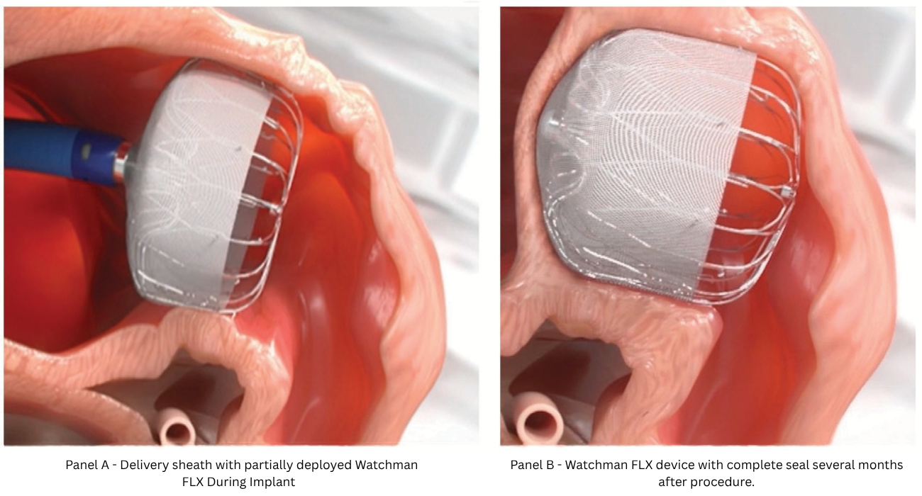 Left Atrial Appendage Occlusion - Healthcare and Medical News for ...
