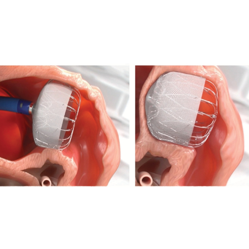 Left Atrial Appendage Occlusion - Healthcare and Medical News for ...
